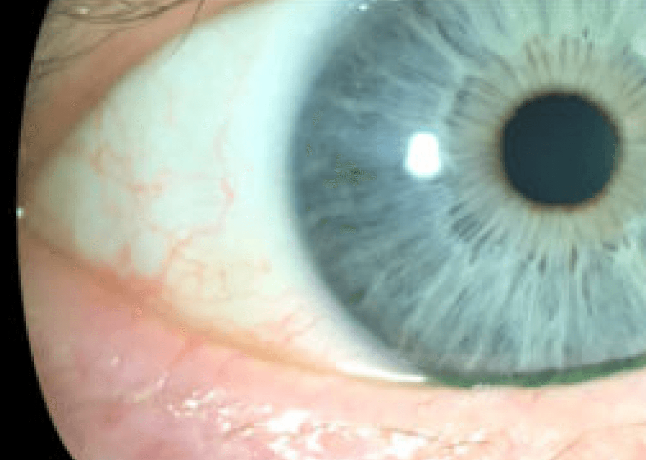 OptiLIGHT - Dry Eye Medical Device | Lumenis