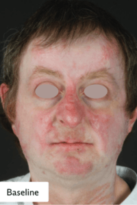 ULTRApulse Alpha: CO2 Laser machine for Skin Rejuvenation - Lumenis