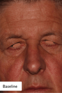 ULTRApulse Alpha: CO2 Laser machine for Skin Rejuvenation - Lumenis