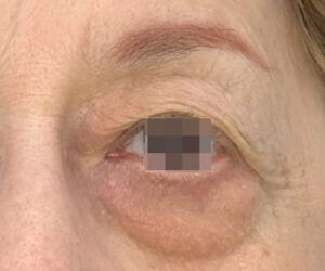 OptiLIFT: Lower Eyelid Laxity Treatment Machine - Lumenis