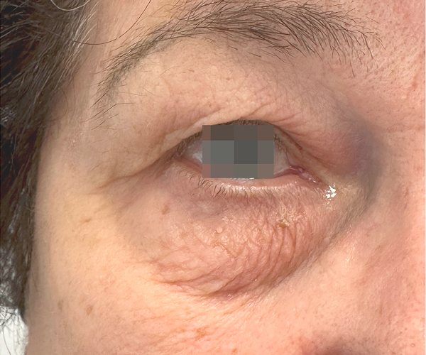 OptiLIFT: Lower Eyelid Laxity Treatment Machine - Lumenis