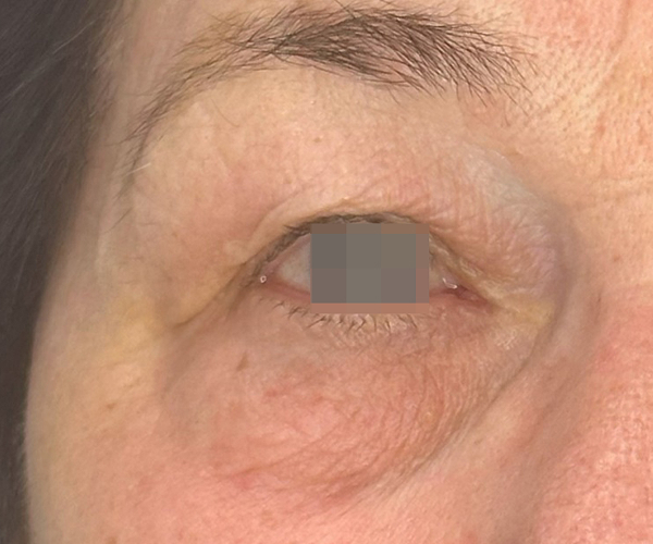 OptiLIFT: Lower Eyelid Laxity Treatment Machine - Lumenis
