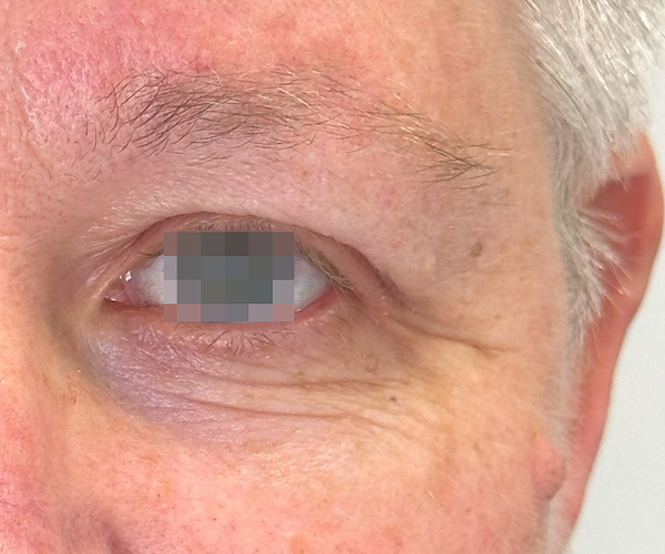 OptiLIFT: Lower Eyelid Laxity Treatment Machine - Lumenis